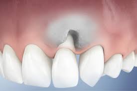 5 signals you need dentures