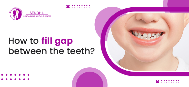How to fill gap between the teeth? - Senthil Dental Clinic