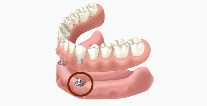 Types of implant supported dentures