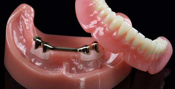 Types of implant supported dentures