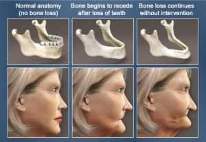 Teeth bone loss treatments | Tooth bone loss treatments