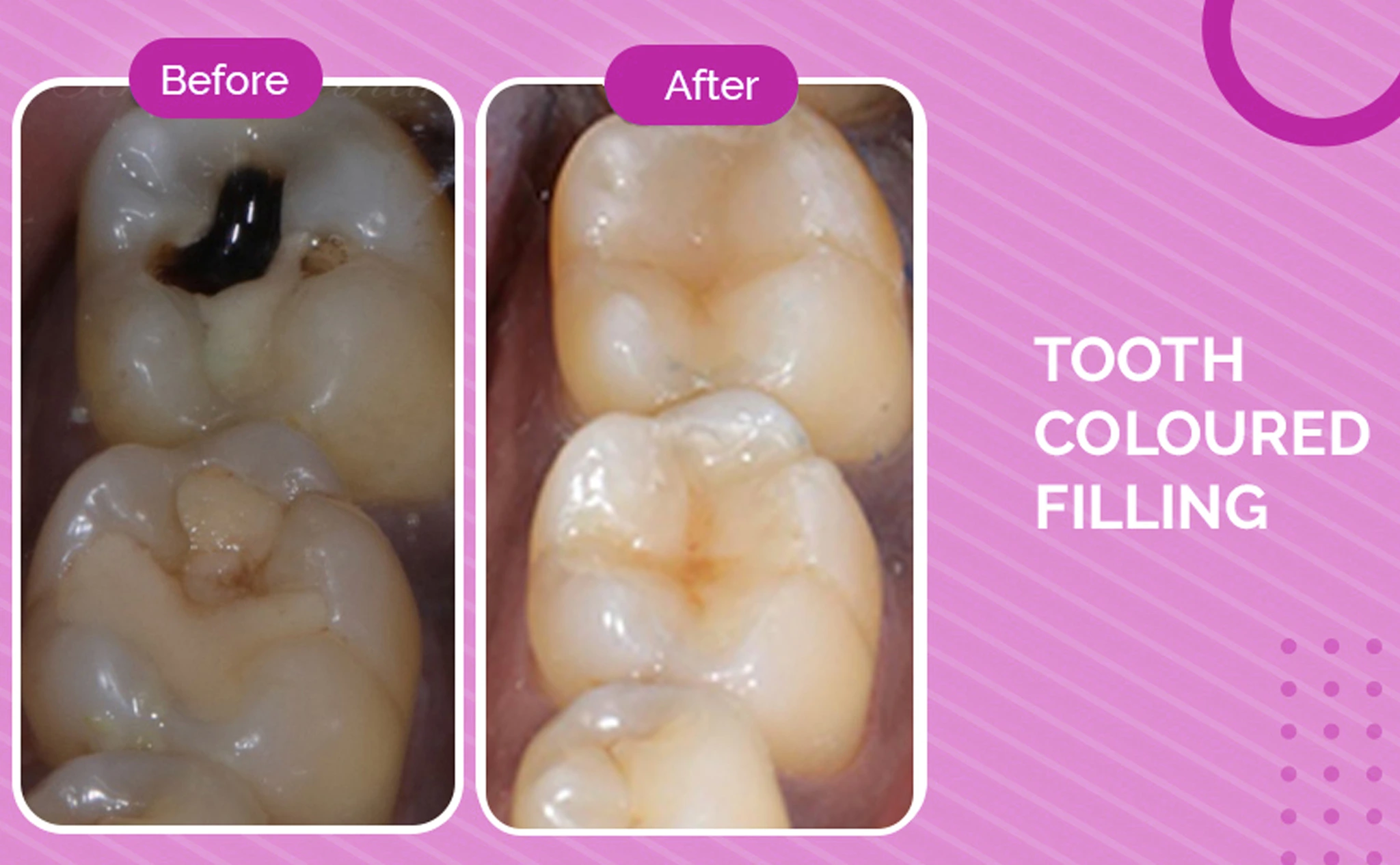 Complete mouth rehabilitation through Denture - Senthil Dental Clinic