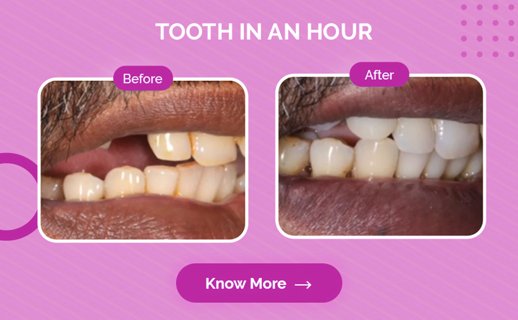 Complete mouth rehabilitation through Denture - Senthil Dental Clinic