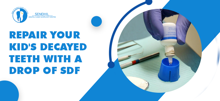 Repair your kid's decayed teeth with a drop of SDF - Senthil Dental Clinic
