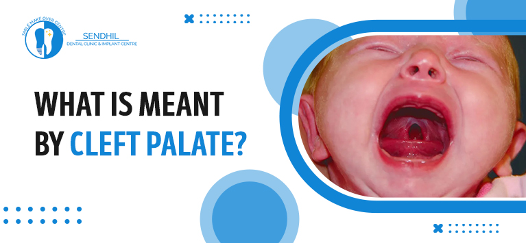What is meant by cleft palate? - Senthil Dental Clinic