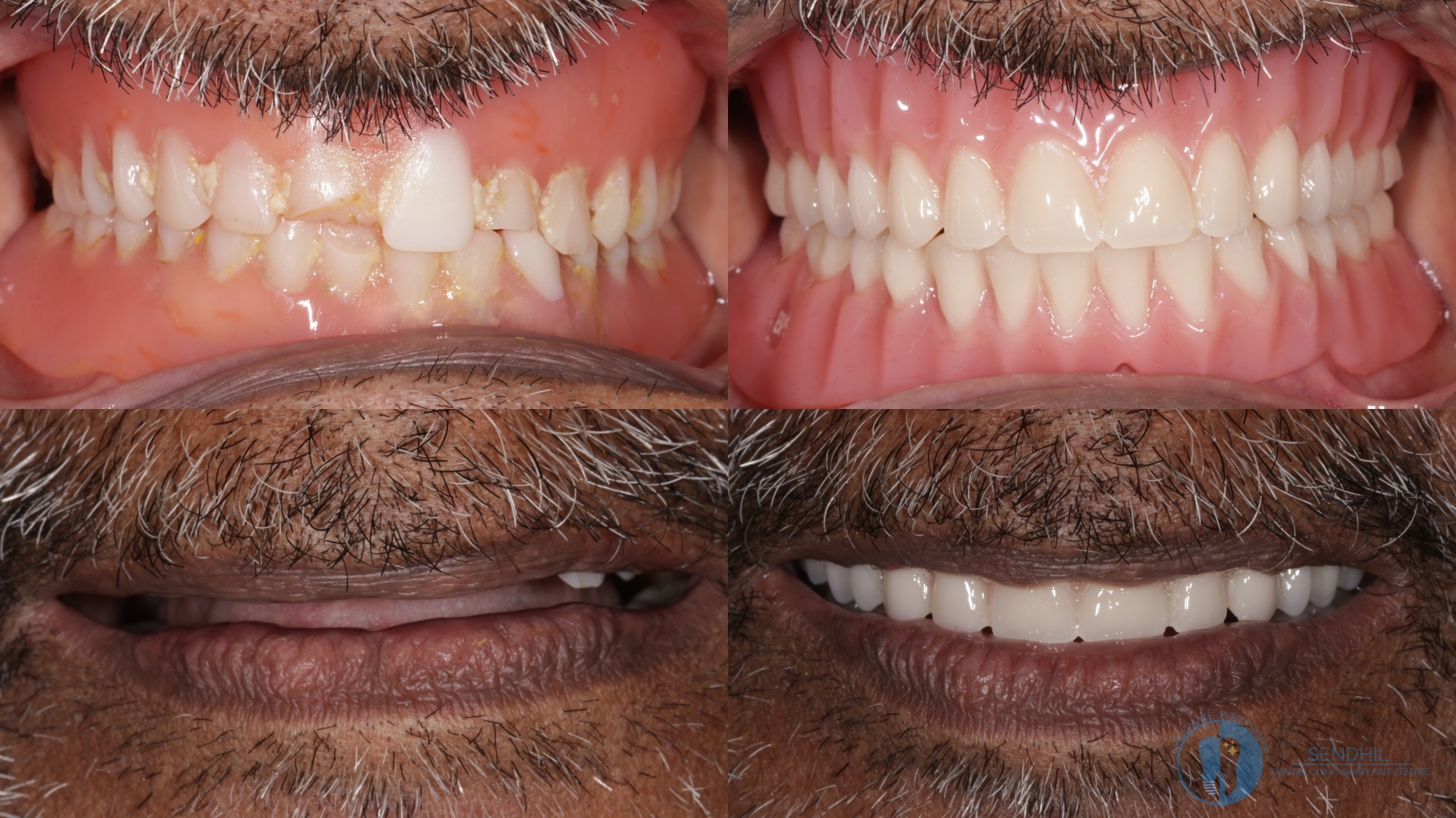 Complete mouth Rehabilitation with denture teeth for an Octogenarian