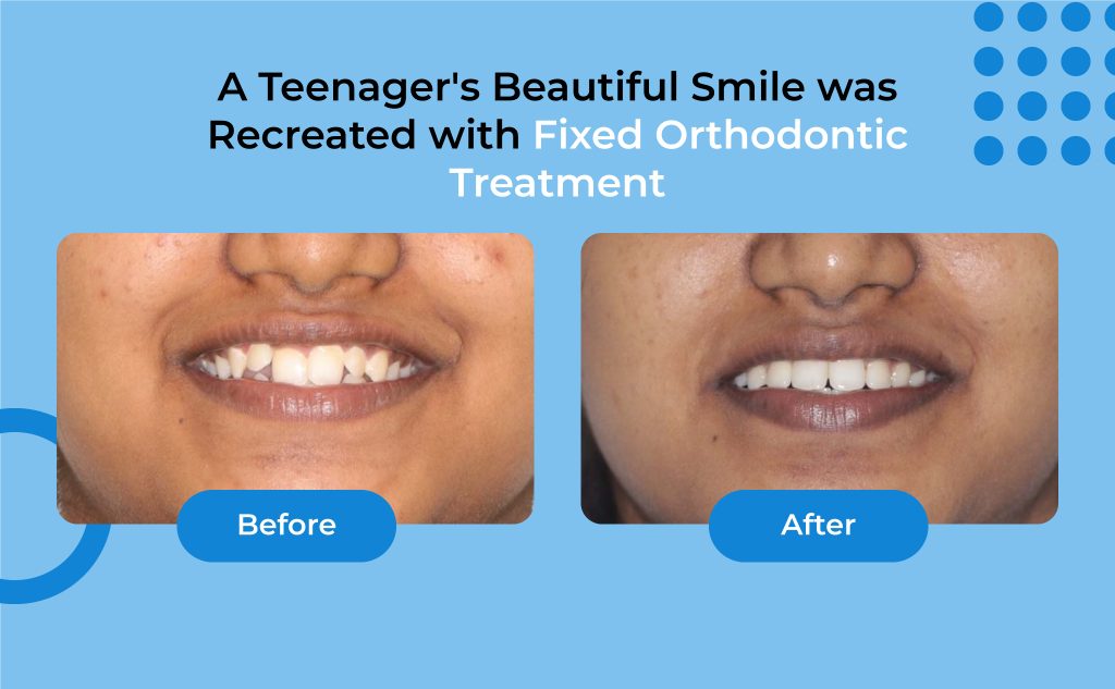 A teenager's beautiful smile was recreated with fixed orthodontic treatment