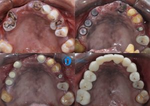 Smile restoration with implants for an Addison's disease patient