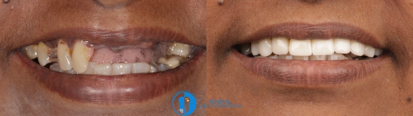 Smile restoration with implants for an Addison's disease patient