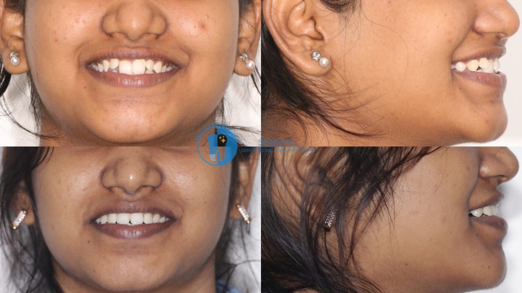 A teenager's beautiful smile was recreated with fixed orthodontic treatment