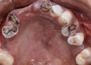 Smile restoration with implants for an Addison's disease patient