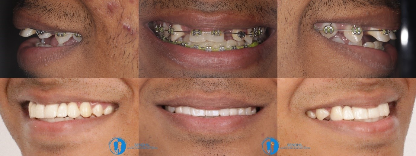 The story of bringing back a stunning smile nearly after a decade