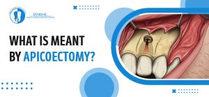 Apicoectomy | Reverse Root Canal | Root End Surgery