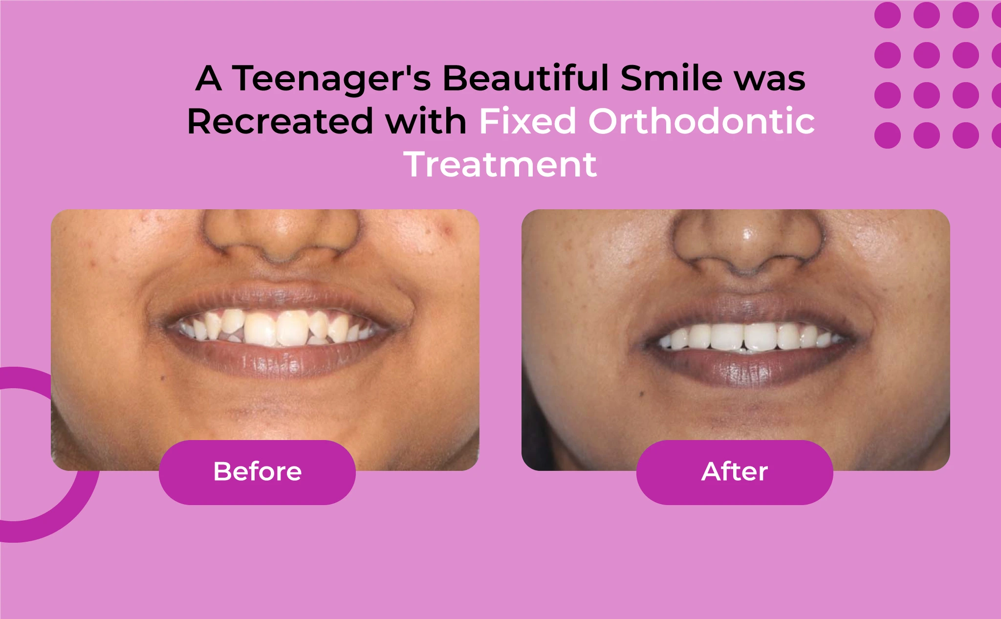A teenager's beautiful smile was recreated with fixed orthodontic treatment
