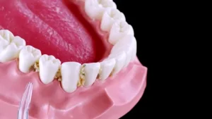 Dealing with Food Stuck in Teeth: How to Handle It