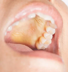 Why Is the Roof of My Mouth Yellow?